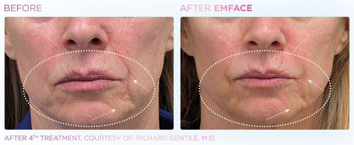 EMFACE Behr Laser Skin Care Center EMFACE Behr Laser Skin Care Center