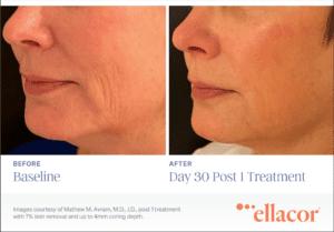 ellacor® System with Micro-Coring™ | Behr Skin Care Center